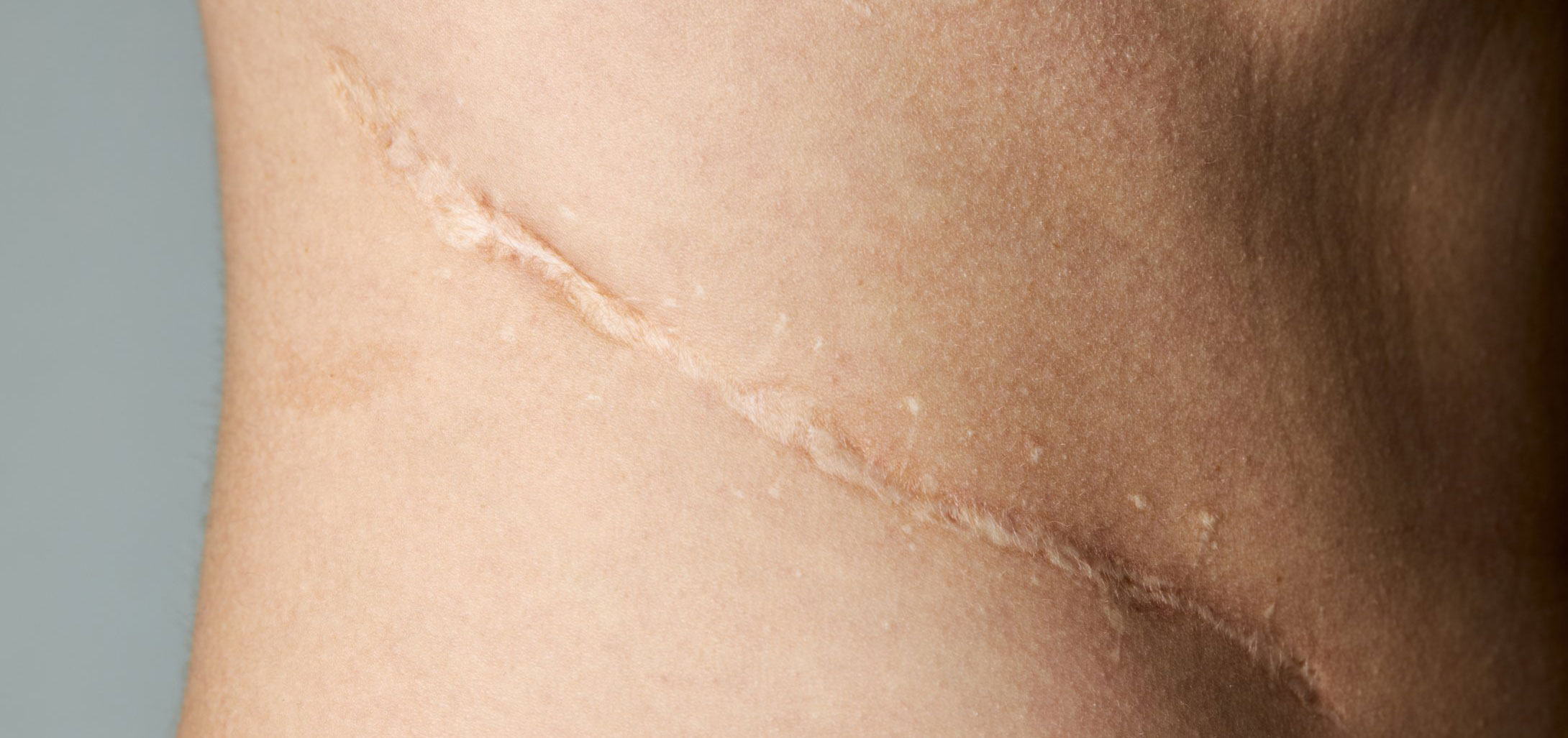 Chrysoula Doula - Scar Reconstruction